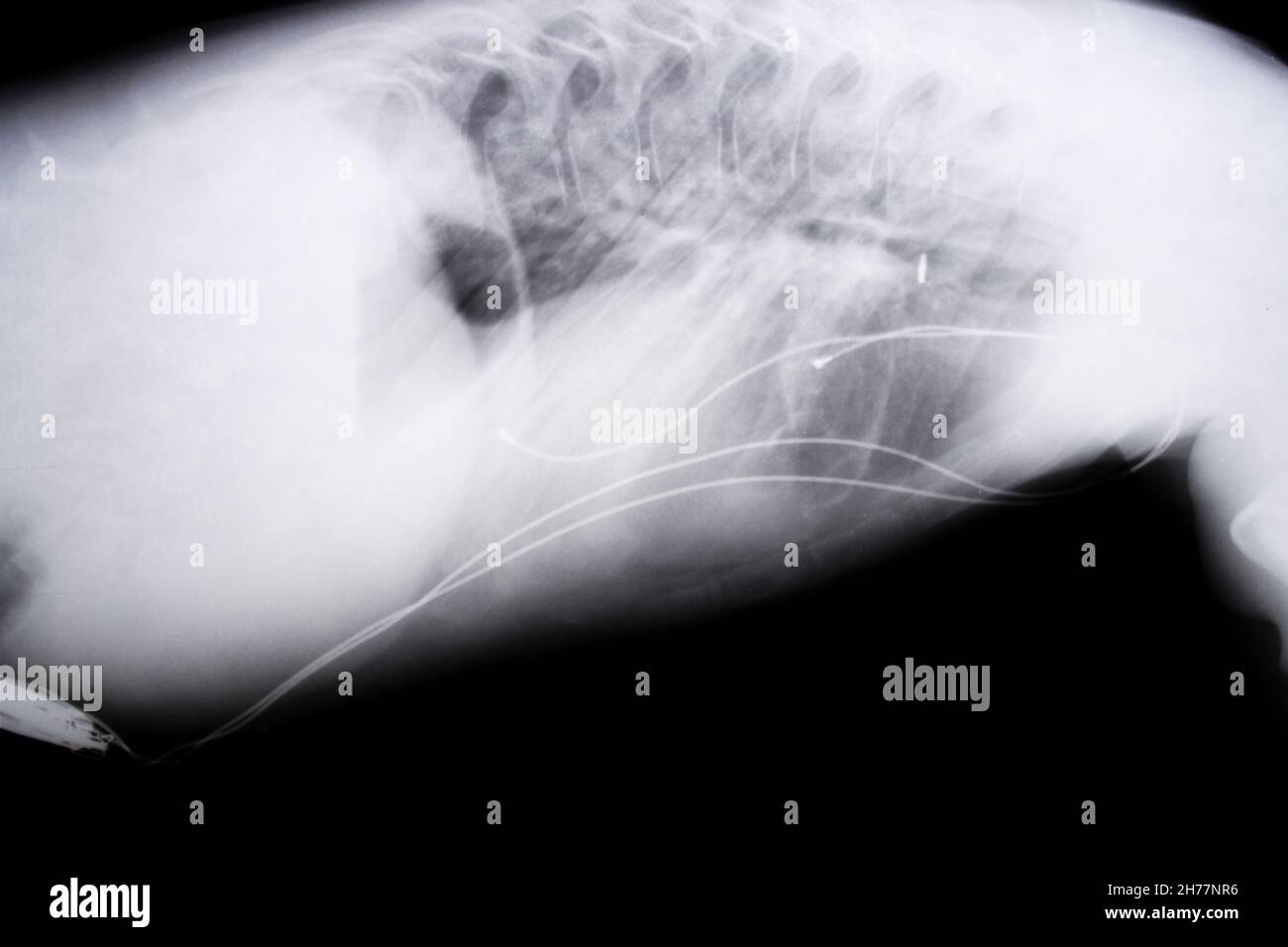 Chest x ray pacemaker hi-res stock photography and images - Alamy