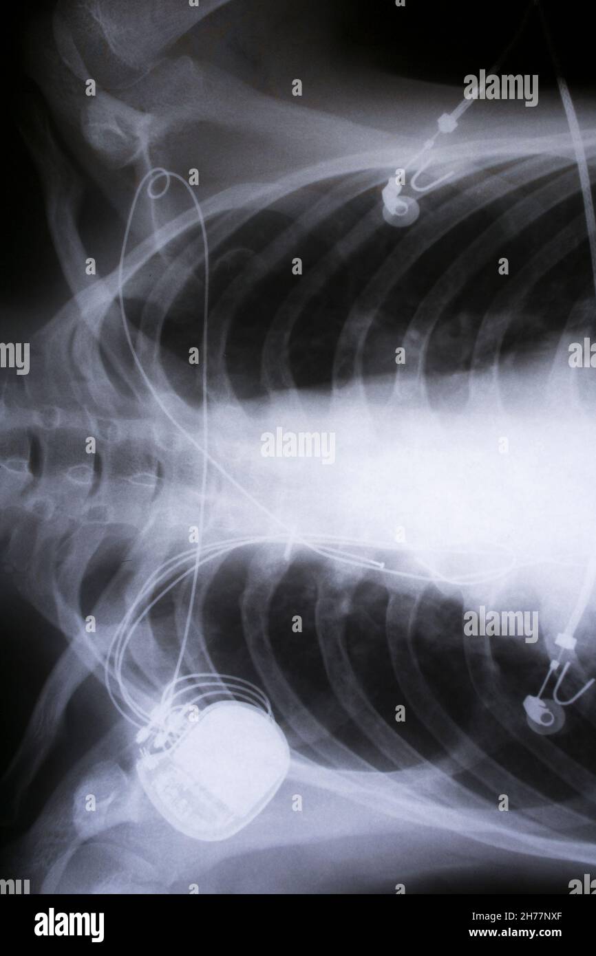 Pacemaker x ray image hi-res stock photography and images - Alamy