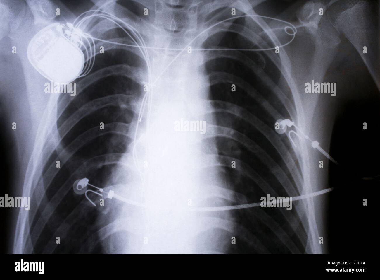 x-ray imagefrom the human chest and pacemaker Stock Photo - Alamy