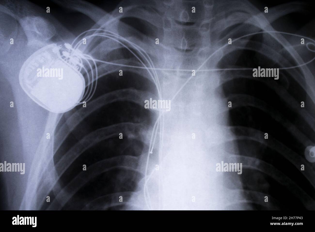 x-ray imagefrom the human chest and pacemaker Stock Photo - Alamy