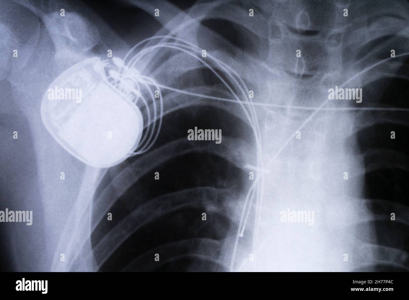 x-ray imagefrom the human chest and pacemaker Stock Photo - Alamy