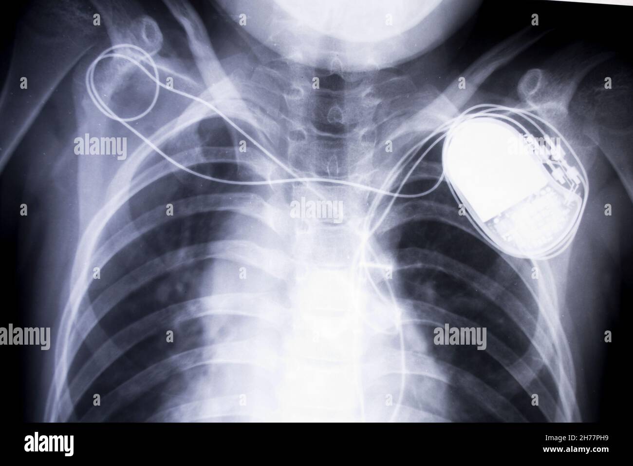 x-ray imagefrom the human chest and pacemaker Stock Photo - Alamy