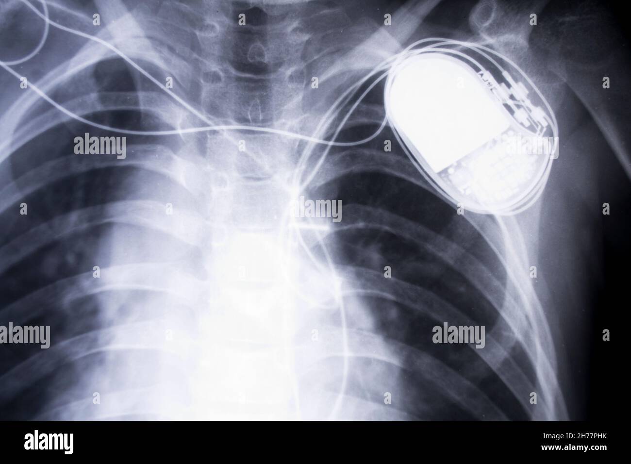 x-ray imagefrom the human chest and pacemaker Stock Photo - Alamy