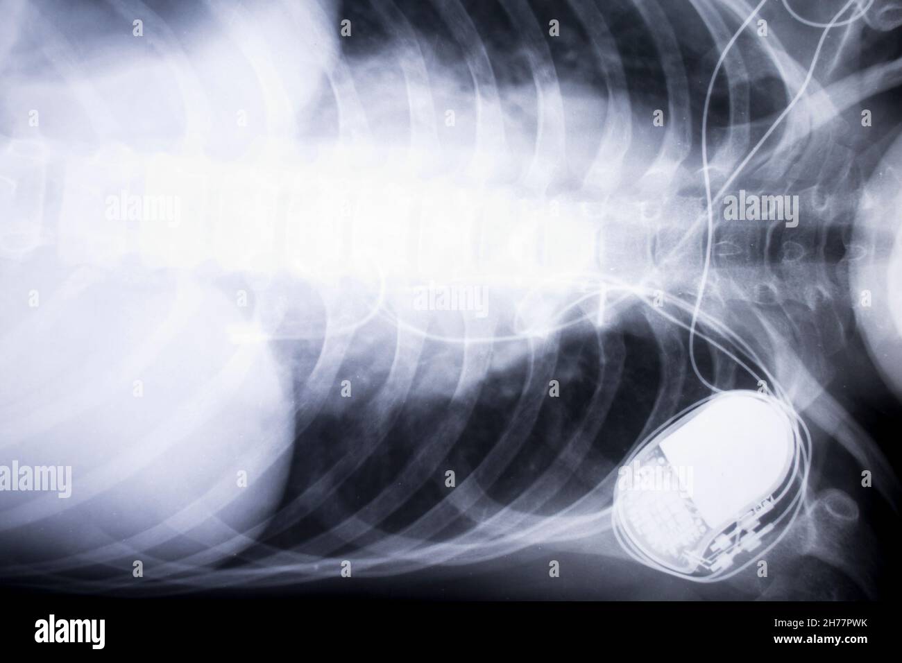 x-ray imagefrom the human chest and pacemaker Stock Photo - Alamy