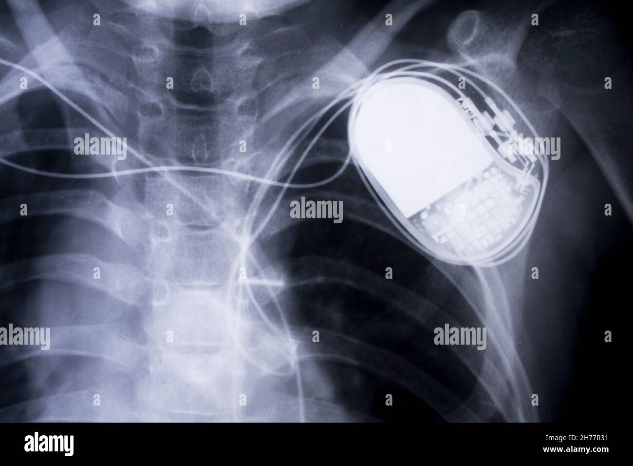 x-ray imagefrom the human chest and pacemaker Stock Photo - Alamy