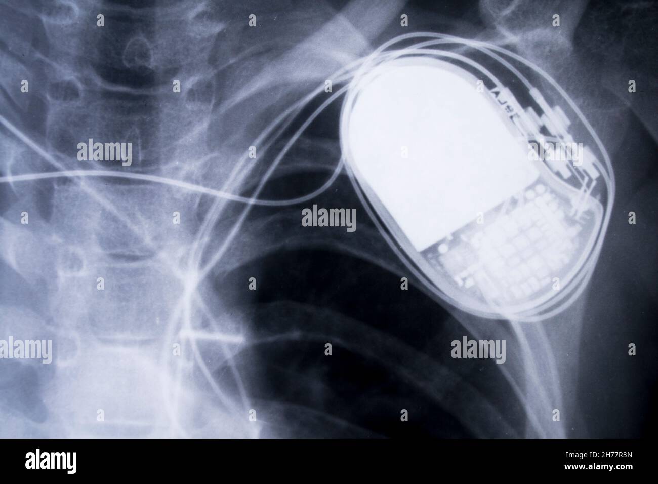 x-ray imagefrom the human chest and pacemaker Stock Photo - Alamy