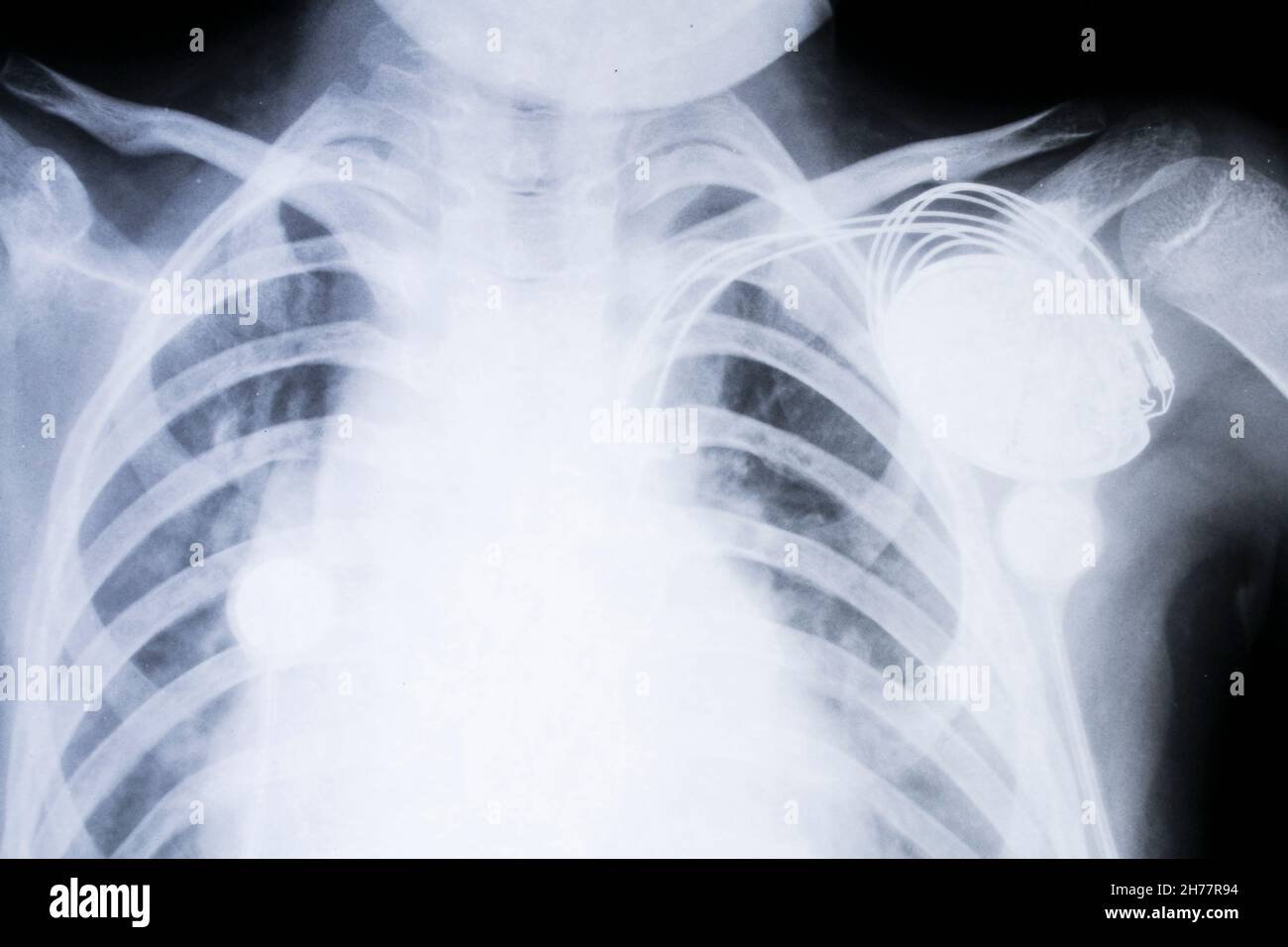 Chest x ray pacemaker hi-res stock photography and images - Alamy