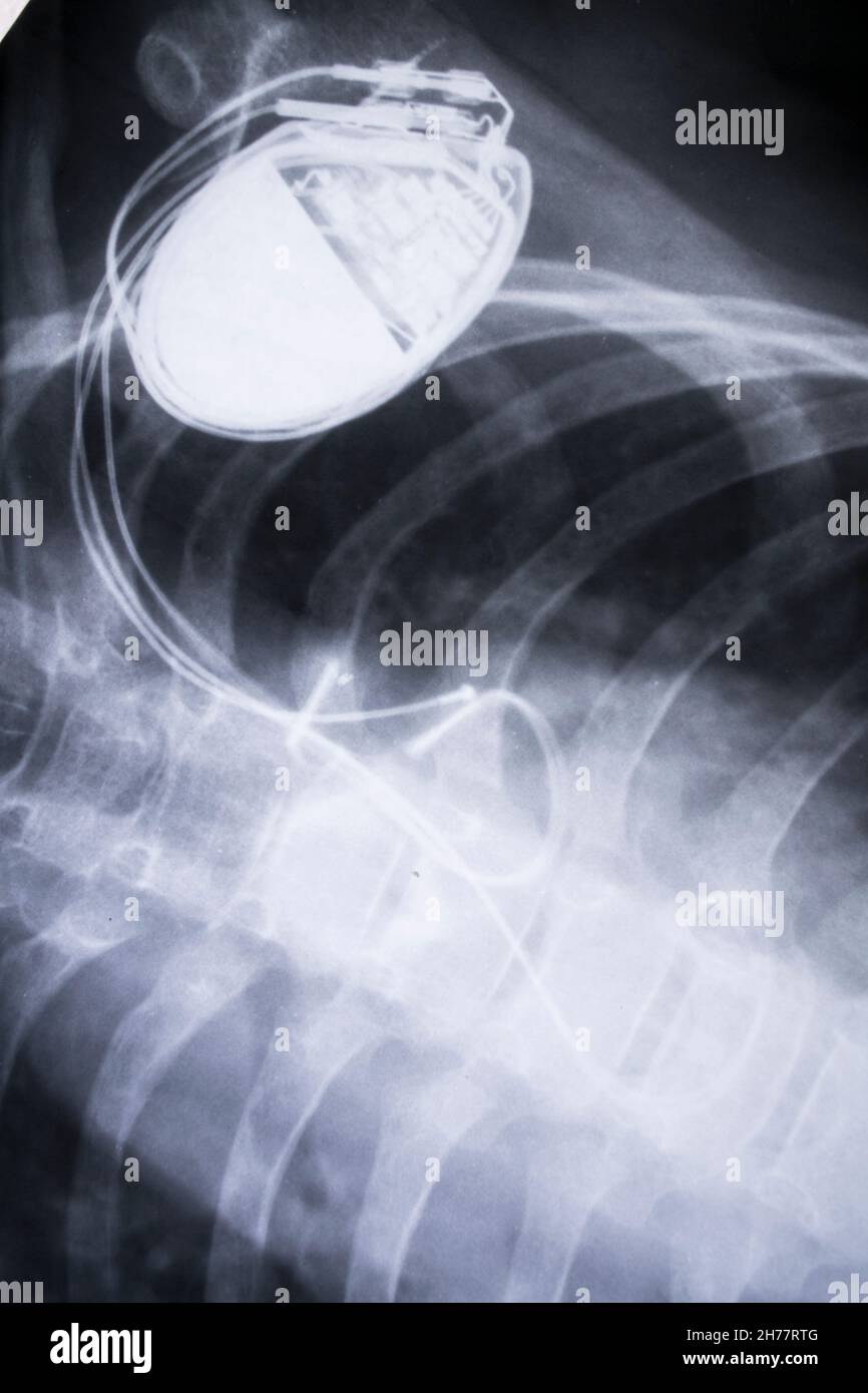 x-ray imagefrom the human chest and pacemaker Stock Photo - Alamy