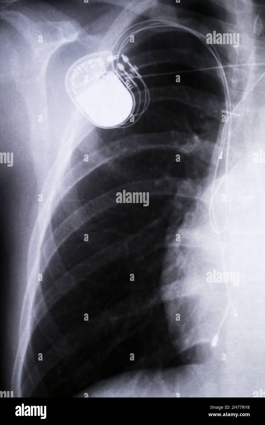 Pacemaker x ray image hi-res stock photography and images - Alamy