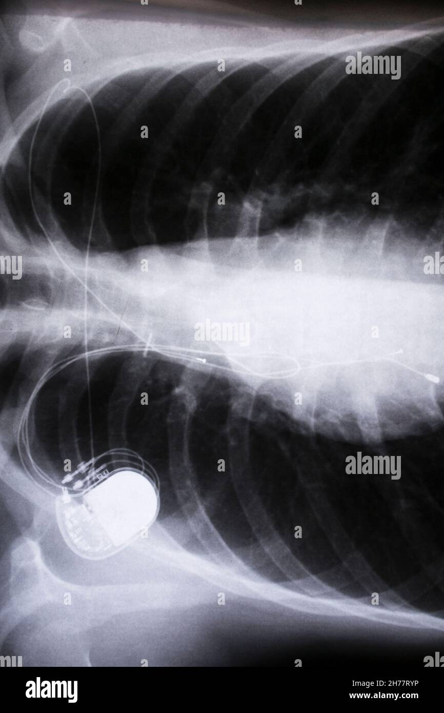 Human chest x ray hi-res stock photography and images - Alamy