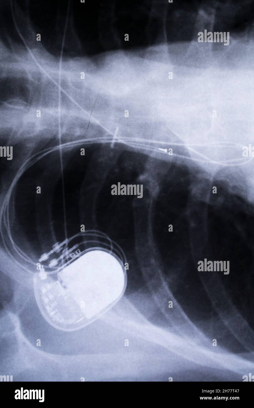 Chest x ray pacemaker hi-res stock photography and images - Alamy