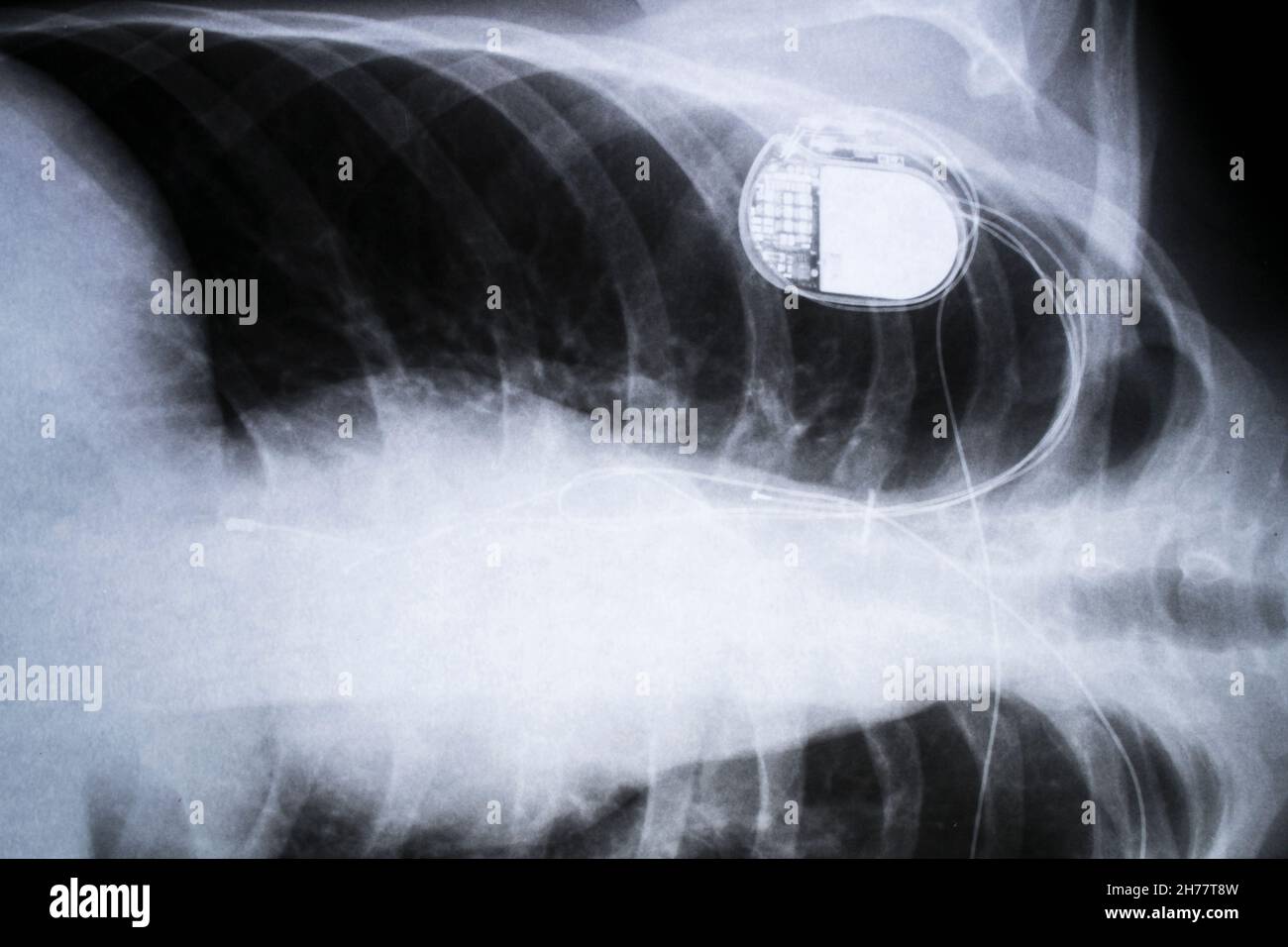 x-ray imagefrom the human chest and pacemaker Stock Photo - Alamy