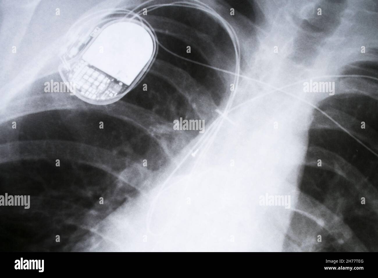Pacemaker x ray image hi-res stock photography and images - Alamy