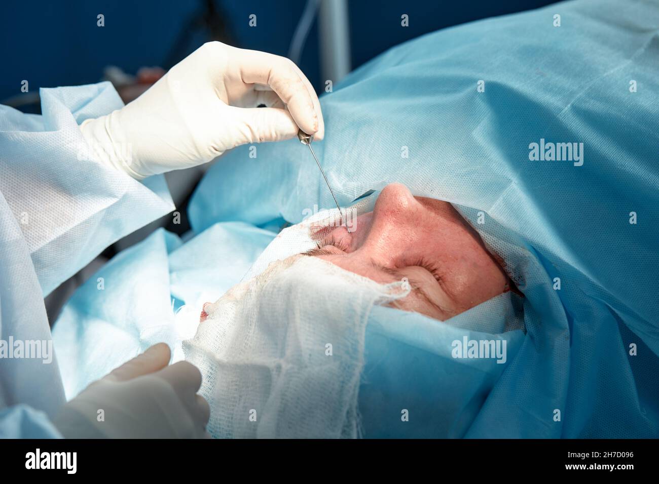 Close up of the face of a patient who is undergoing blepharoplasty. The ...