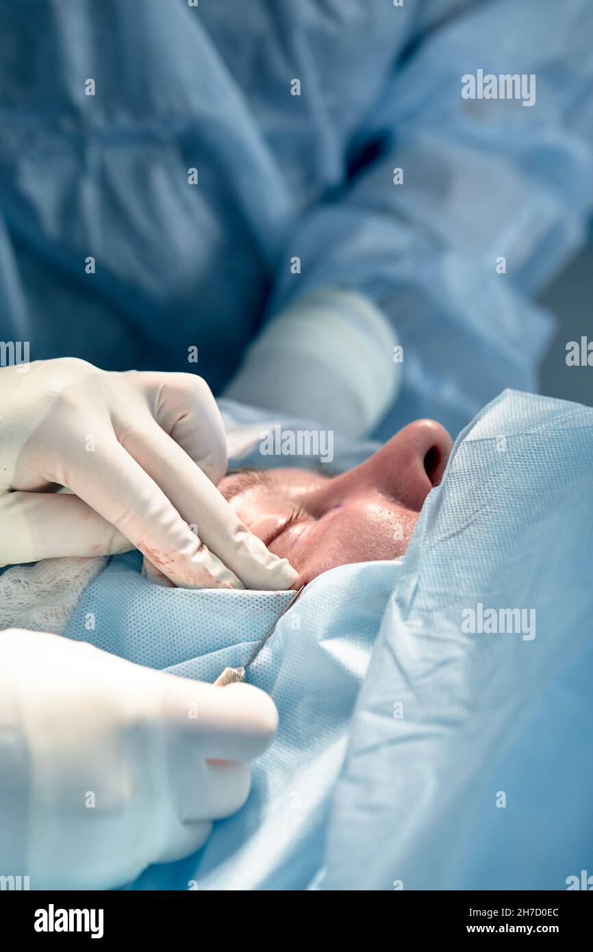 Close up of the face of a patient who is undergoing blepharoplasty. The ...