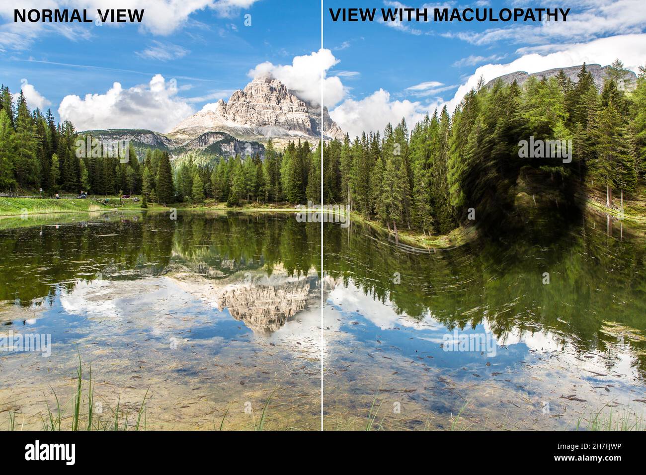 Retinal maculopathy hi-res stock photography and images - Alamy