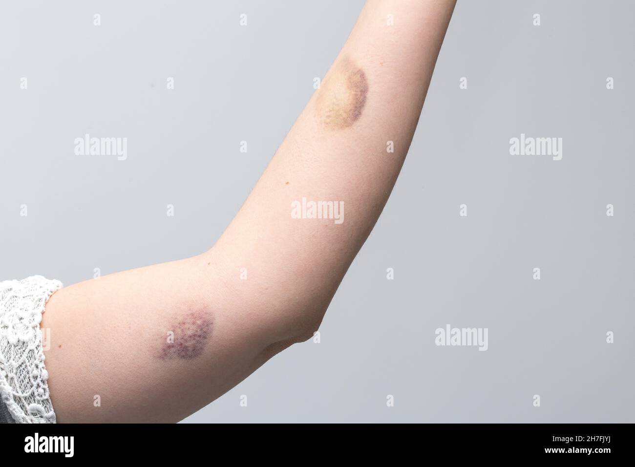 Hematoma arm hi-res stock photography and images - Alamy
