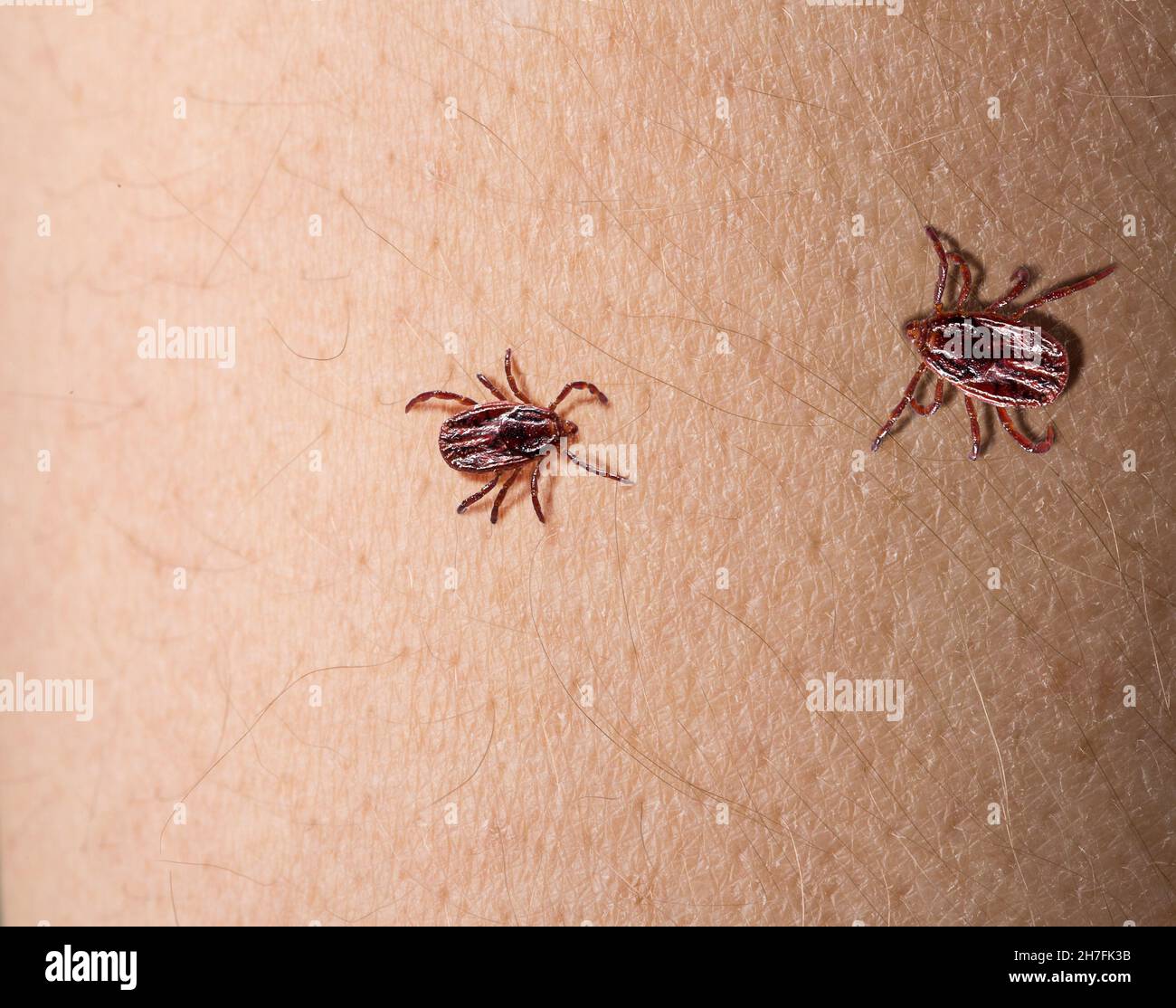 Macro of two ticks on human skin Stock Photo - Alamy