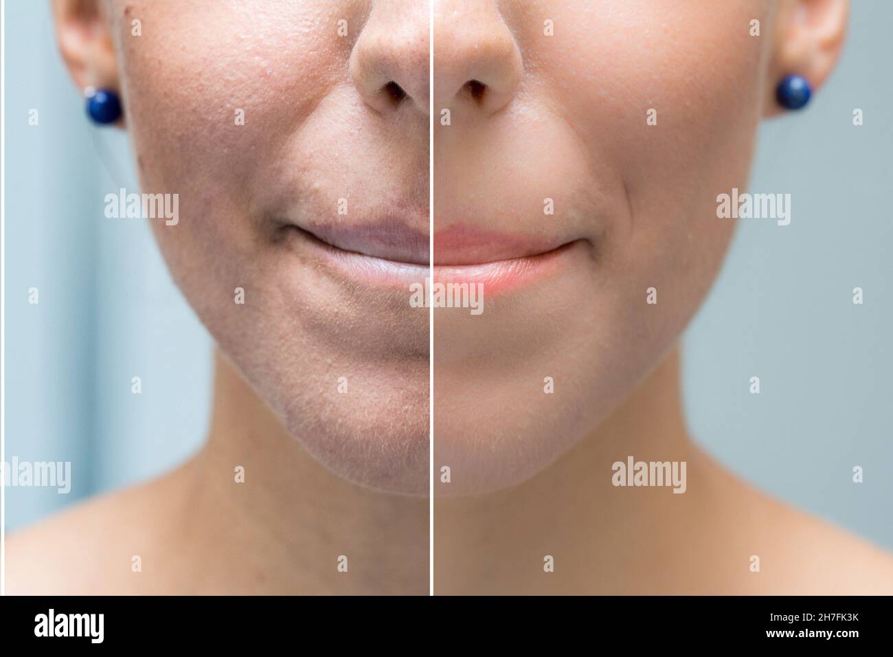 Woman face before and after cosmetic treatment Stock Photo - Alamy