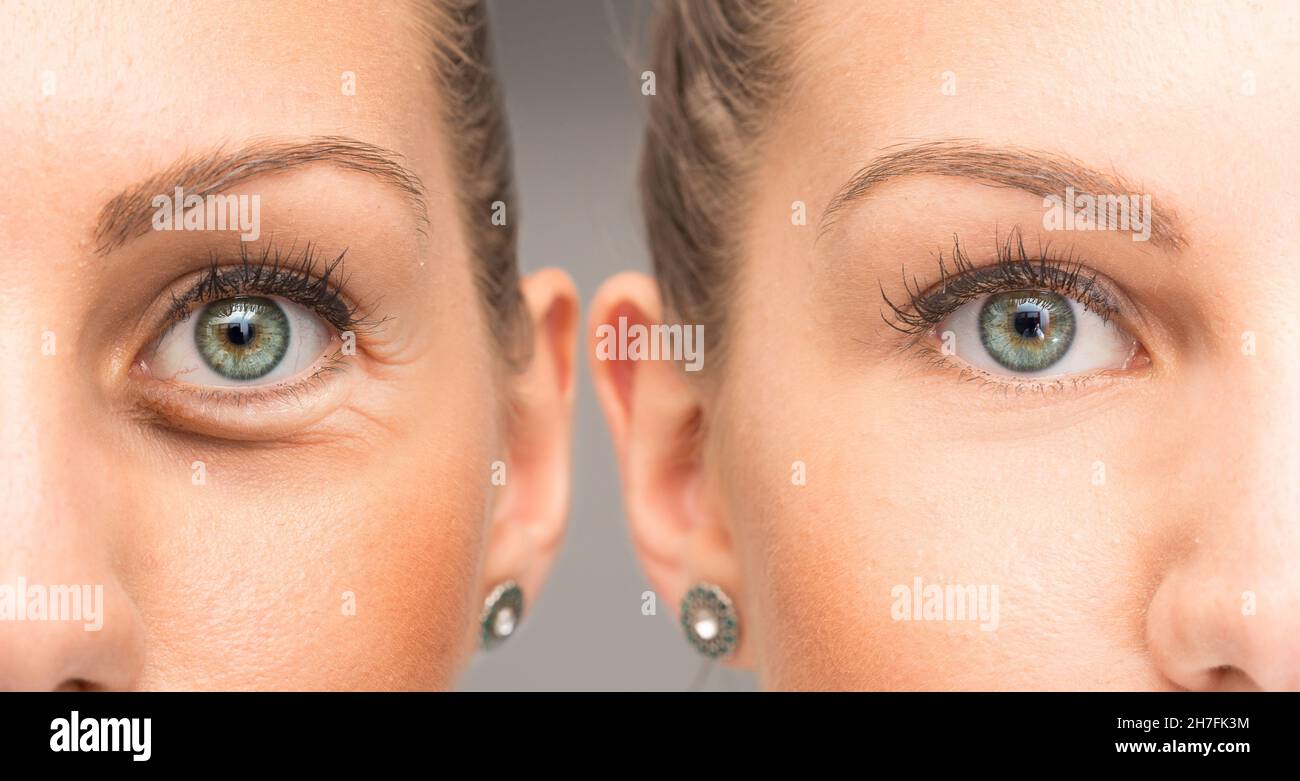 Female eye with wrinkles and crow's feet before and after cosmetic ...