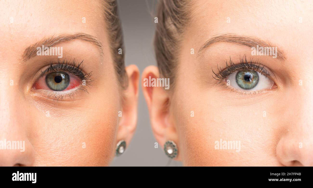 Female half face before and after red eye care, allergy and ...