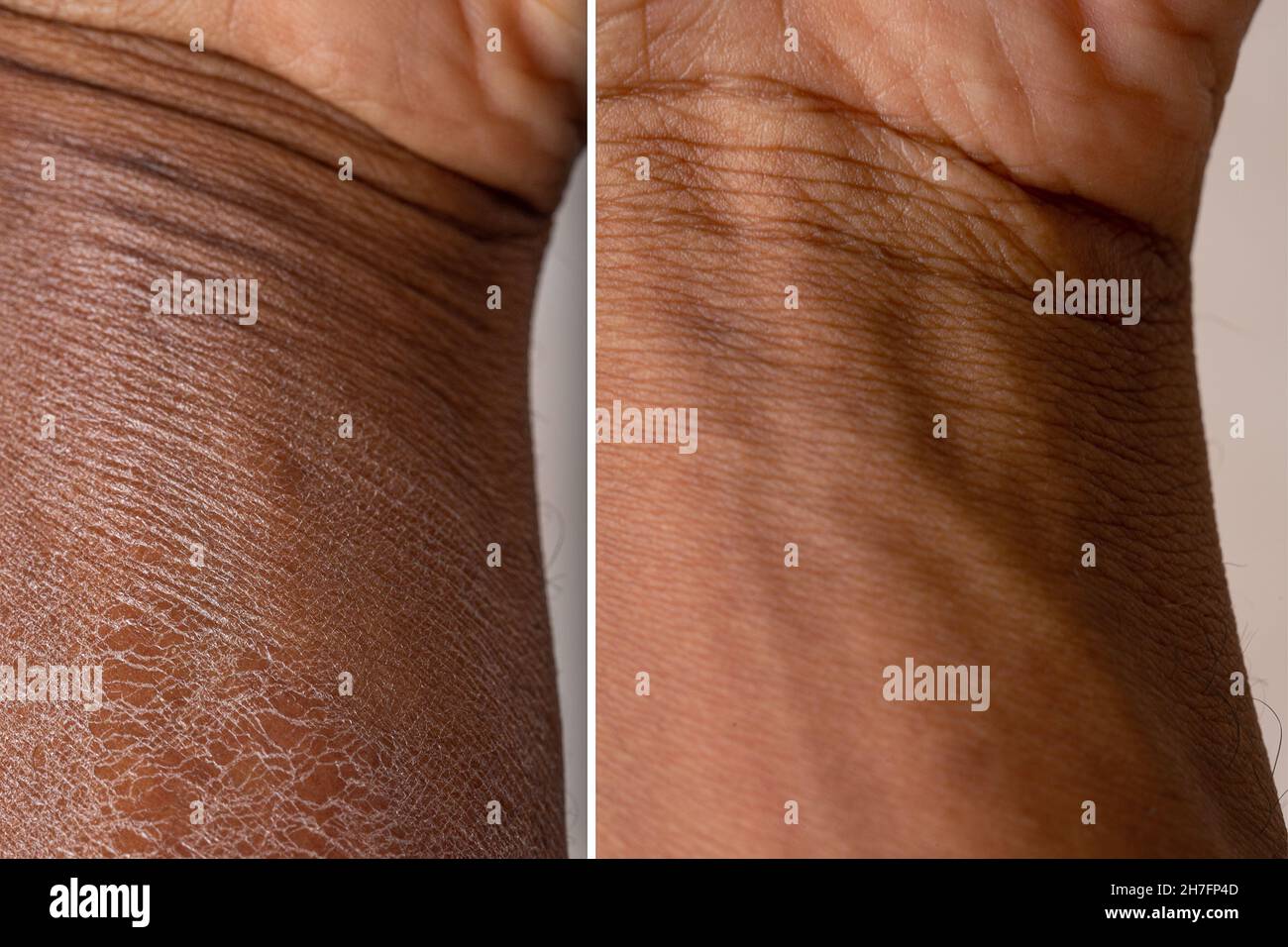 Dry skin in the arm of an African boy before and after using a ...