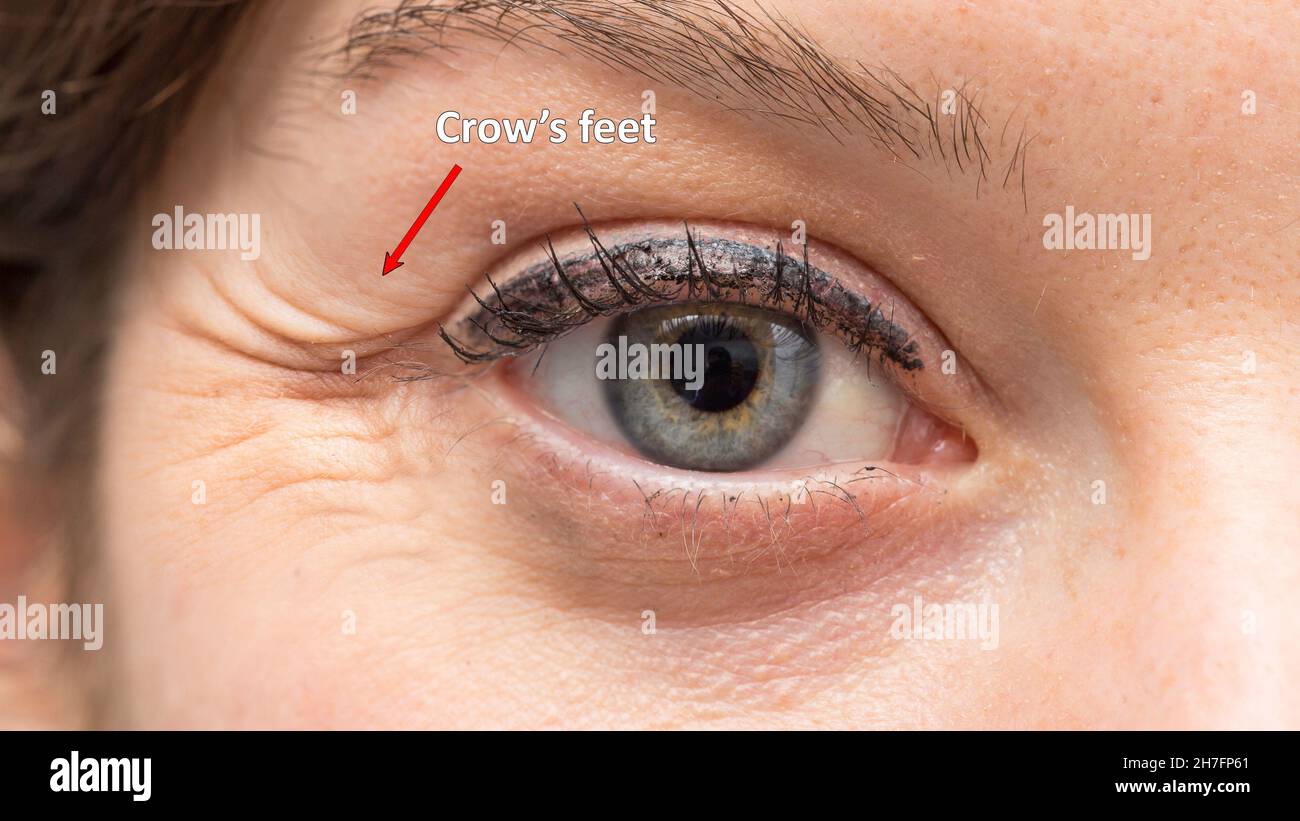 Crows feet are seen extremely close around the eye of Caucasian girl ...