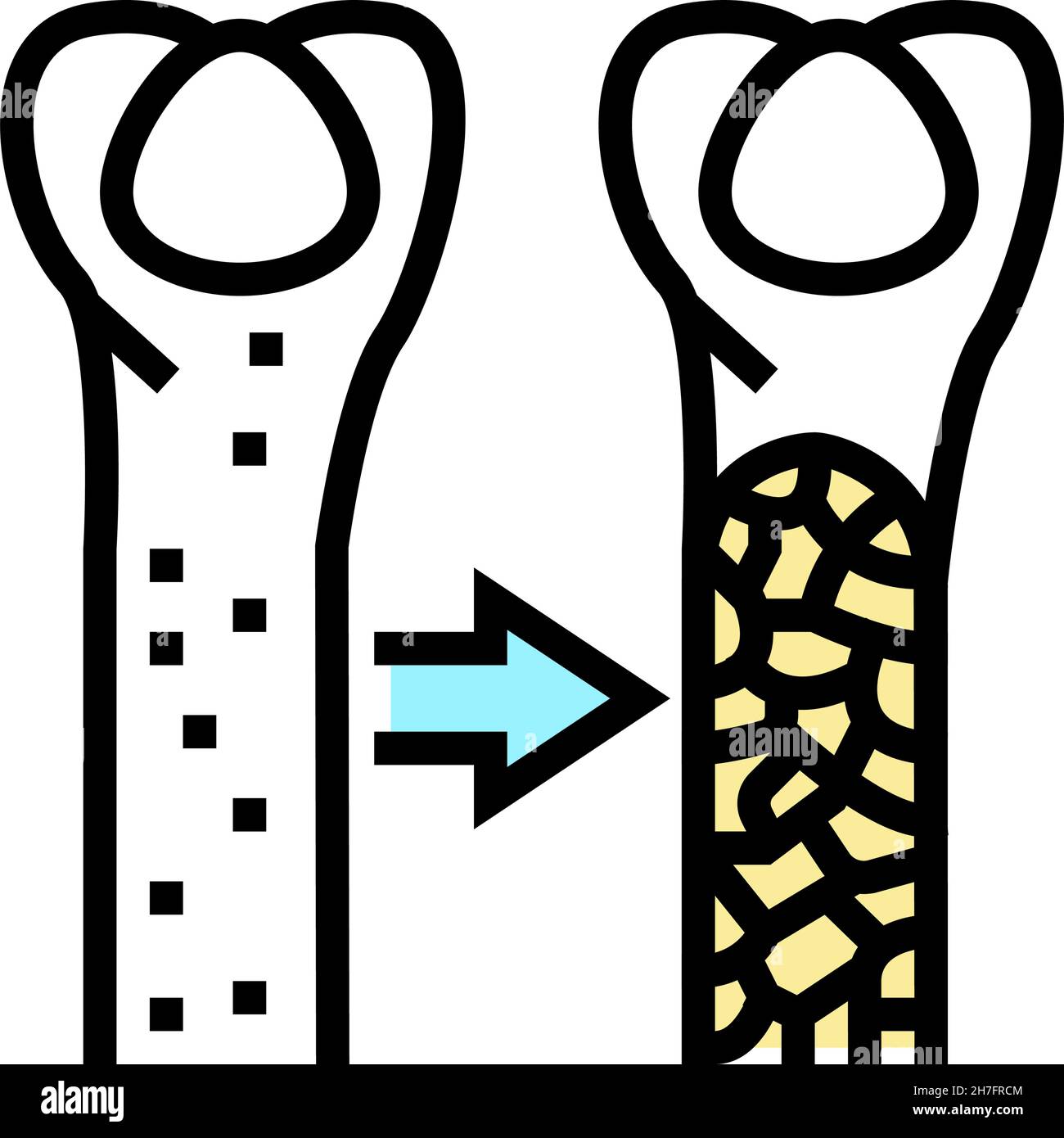 osteoporosis bone disease color icon vector illustration Stock Vector ...