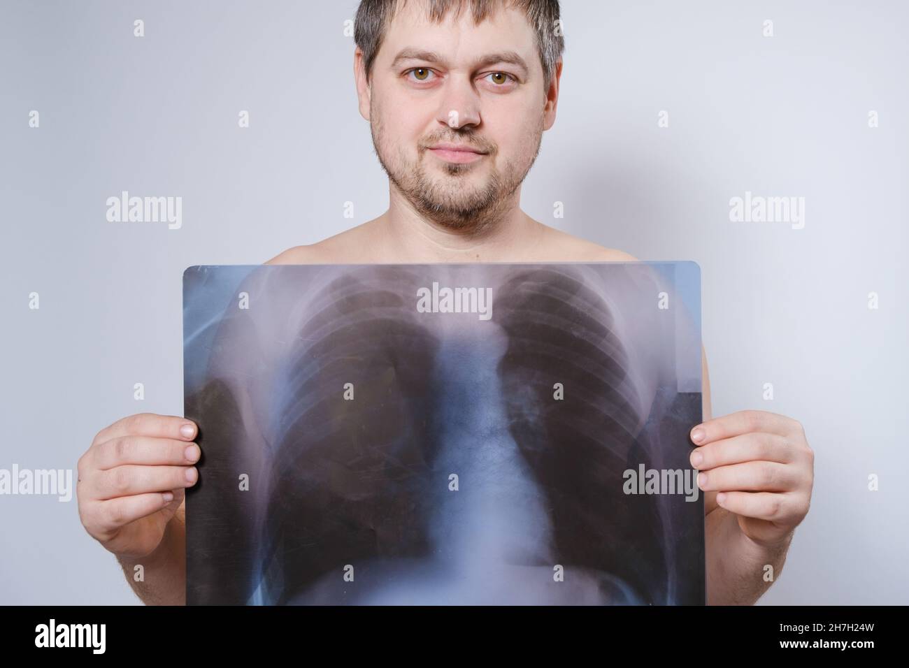 A man holds an X-ray image of her lungs at chest level Stock Photo - Alamy