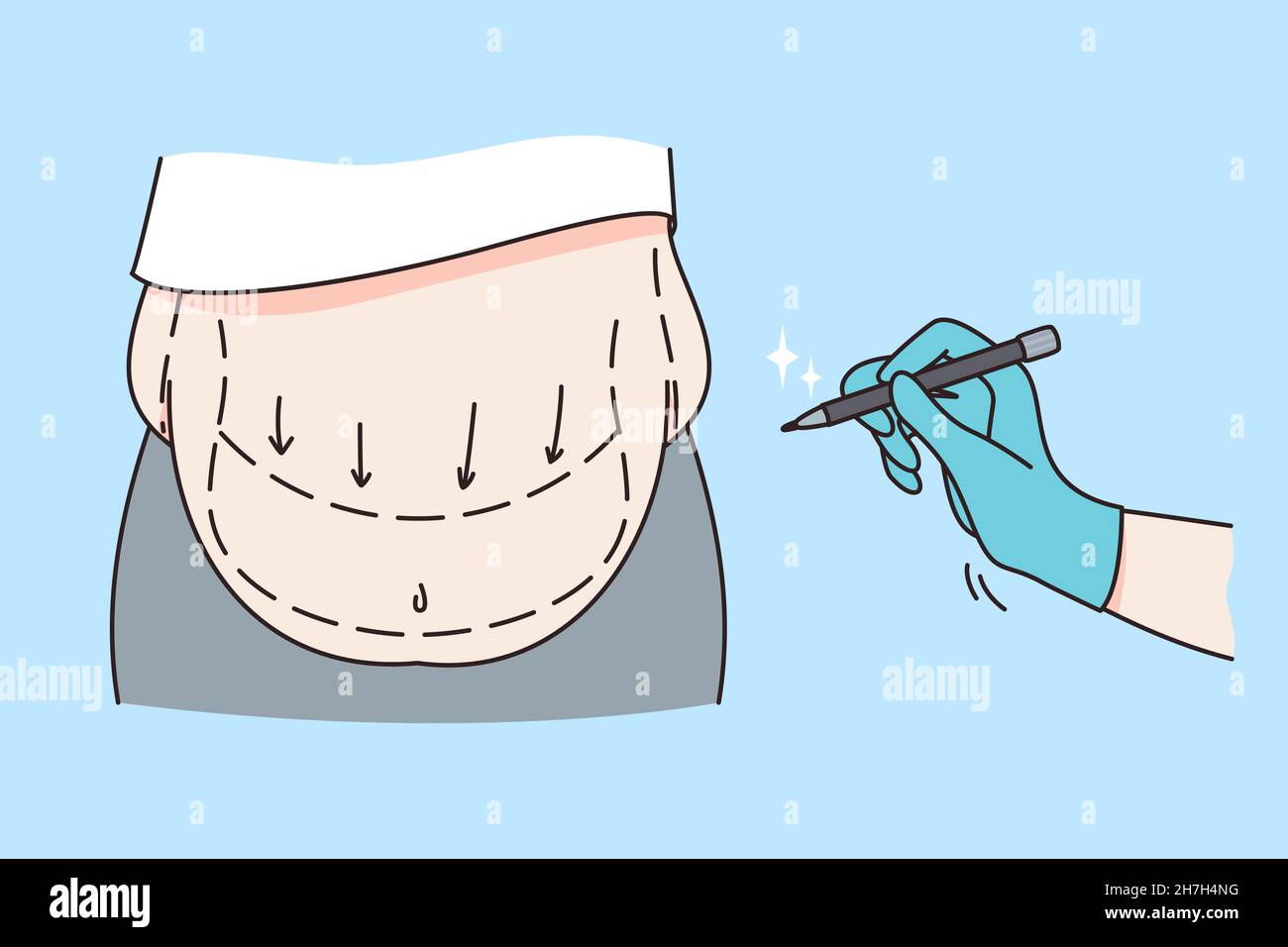 Body care and liposuction concept. Belly of female with overweight and ...