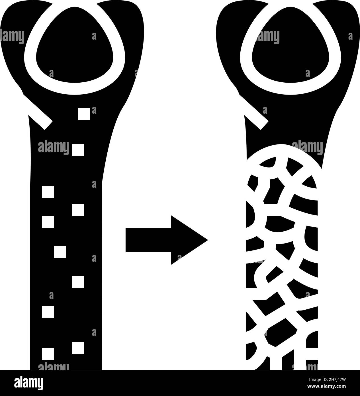 osteoporosis bone disease glyph icon vector illustration Stock Vector ...