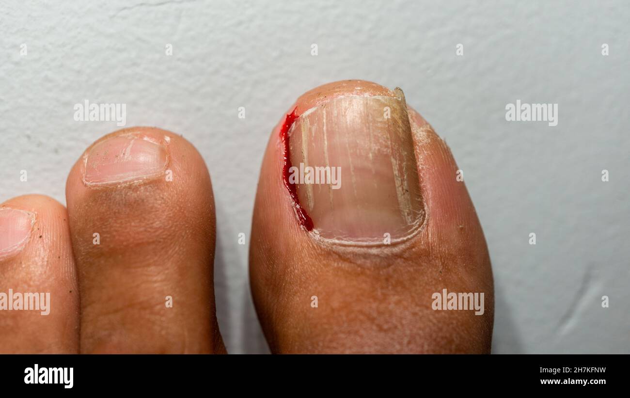 Blood coming out because of Ingrown Toenail Stock Photo - Alamy