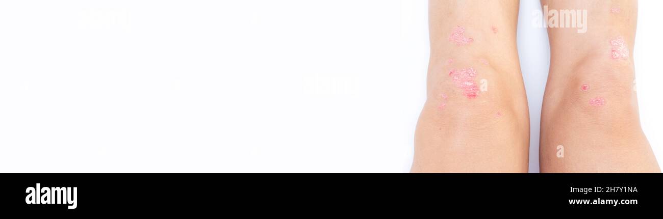 Knee joint effusion (water on knee) Acute psoriatic arthritis ...