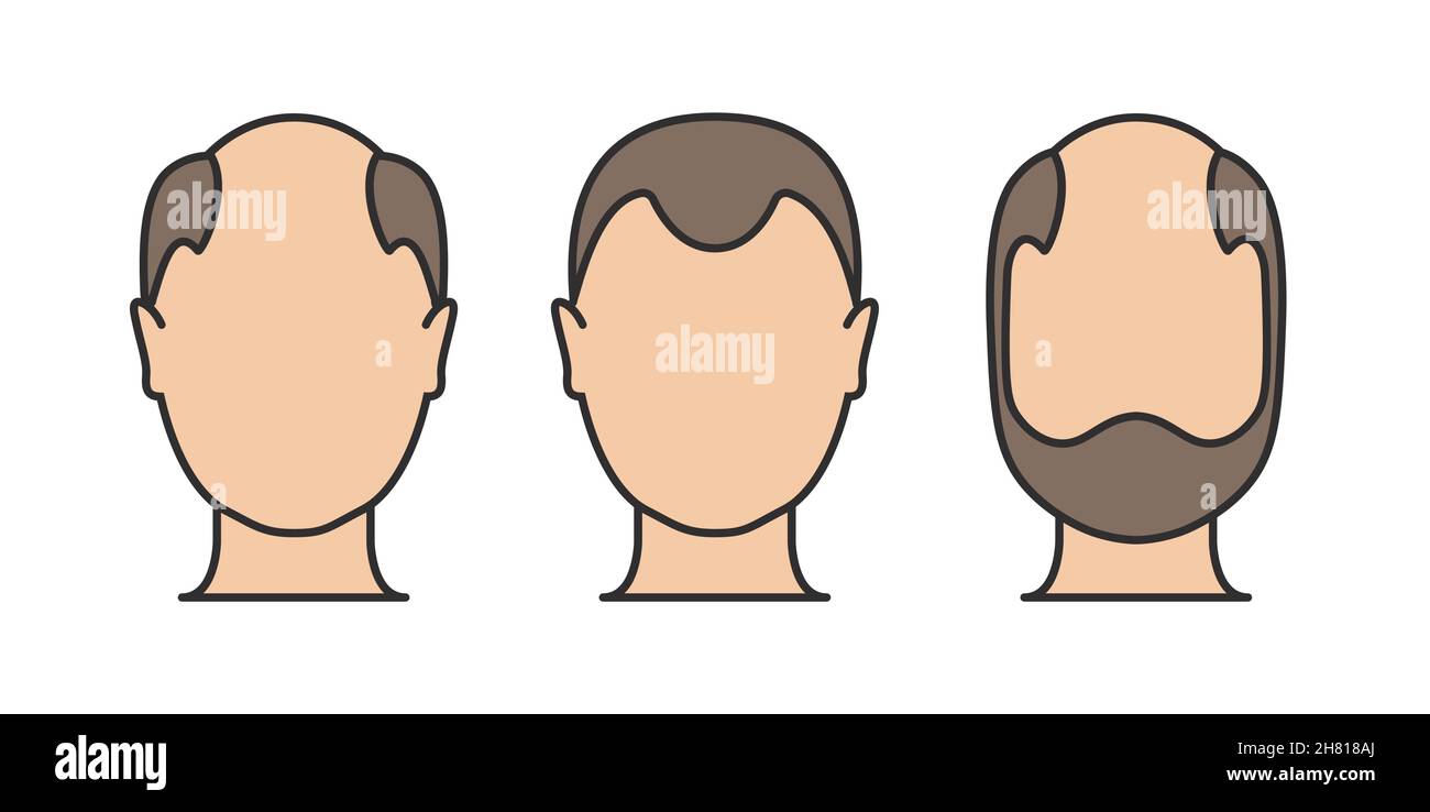 Hair loss man icon cartoon vector logo. Hair loss male scalp bald ...