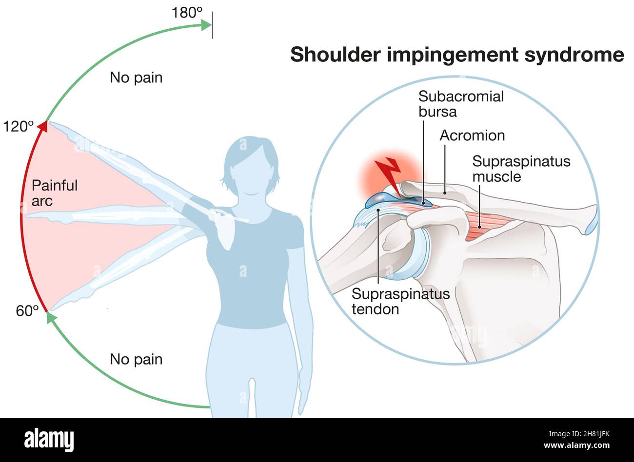 Illustration showing shoulder impingement syndrome and painful arc ...