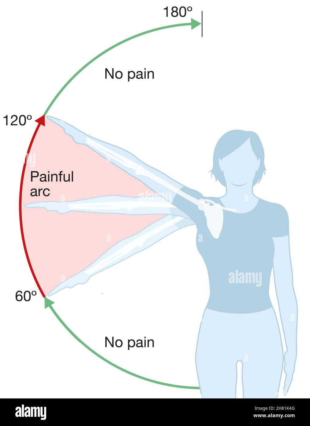 Illustration showing shoulder impingement syndrome and painful arc ...