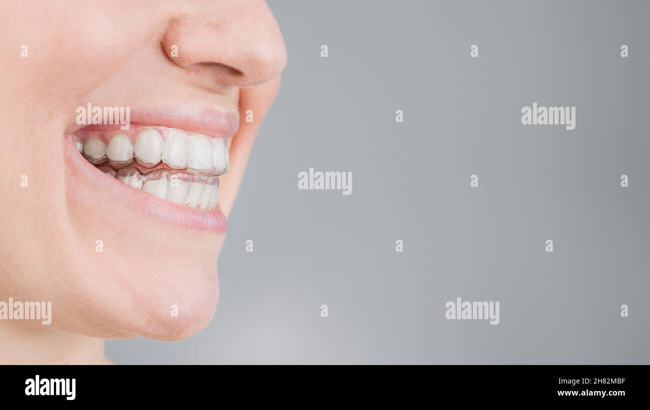 Close-up portrait of a woman putting on a transparent plastic retainer ...