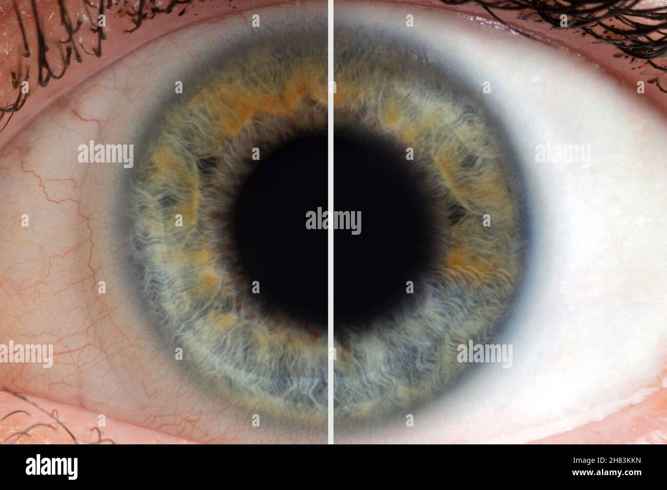 human eye with blood vessels before and after Stock Photo - Alamy