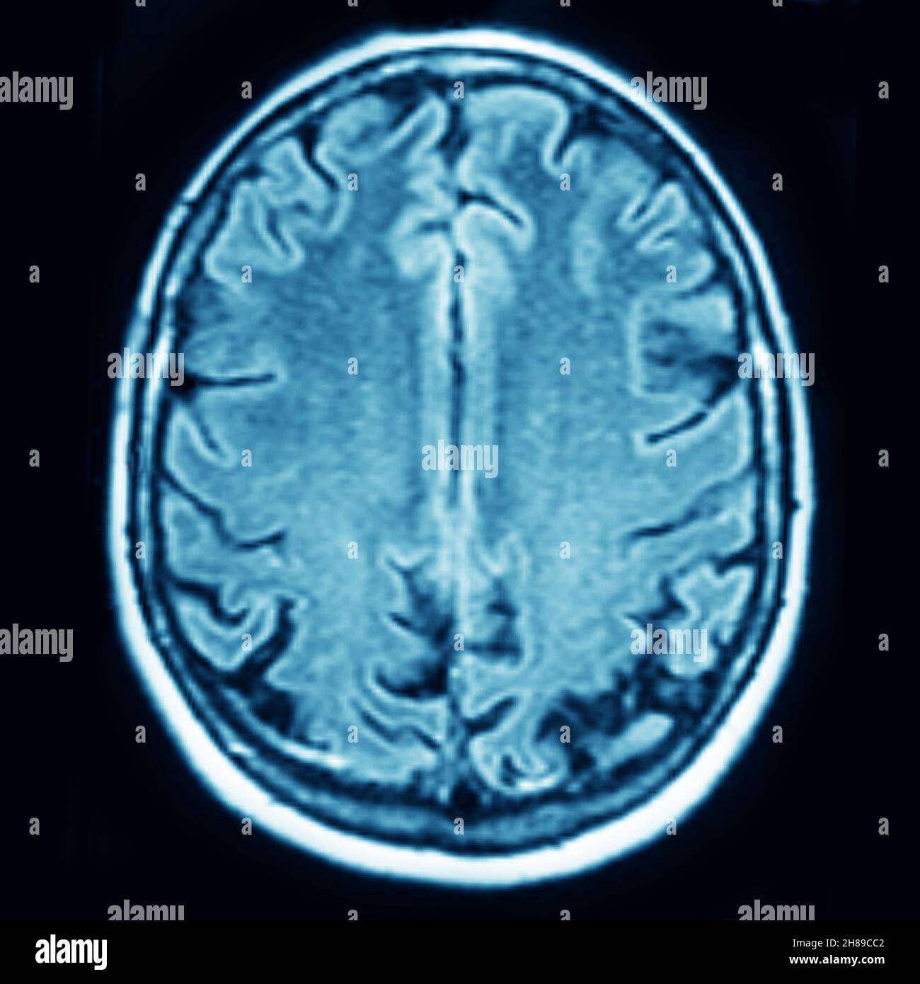 Brain paralysis hi-res stock photography and images - Alamy