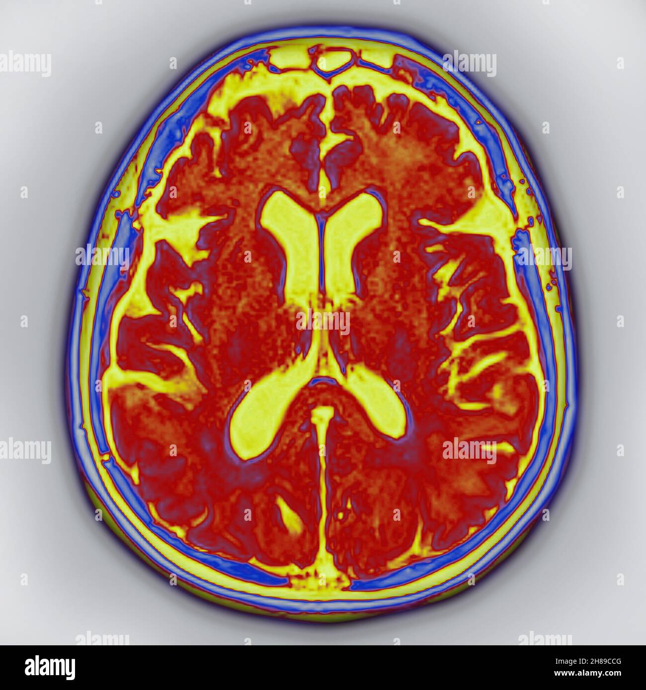 Alzheimers brain hi-res stock photography and images - Alamy