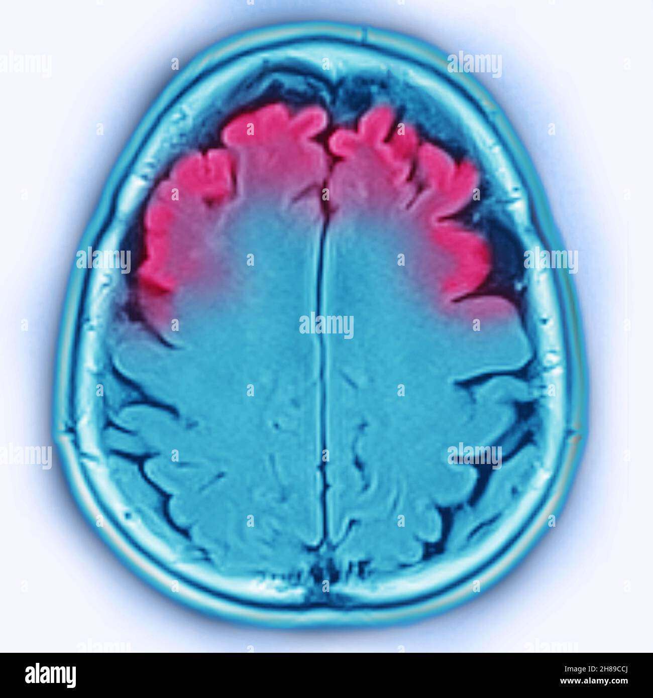 Brain atrophy alzheimer hi-res stock photography and images - Alamy