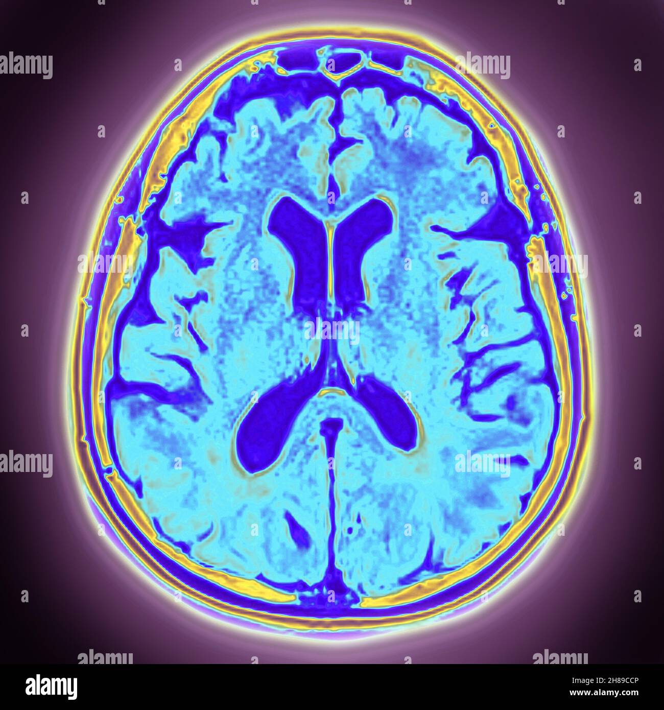 Brain pathology cerebrum hi-res stock photography and images - Alamy