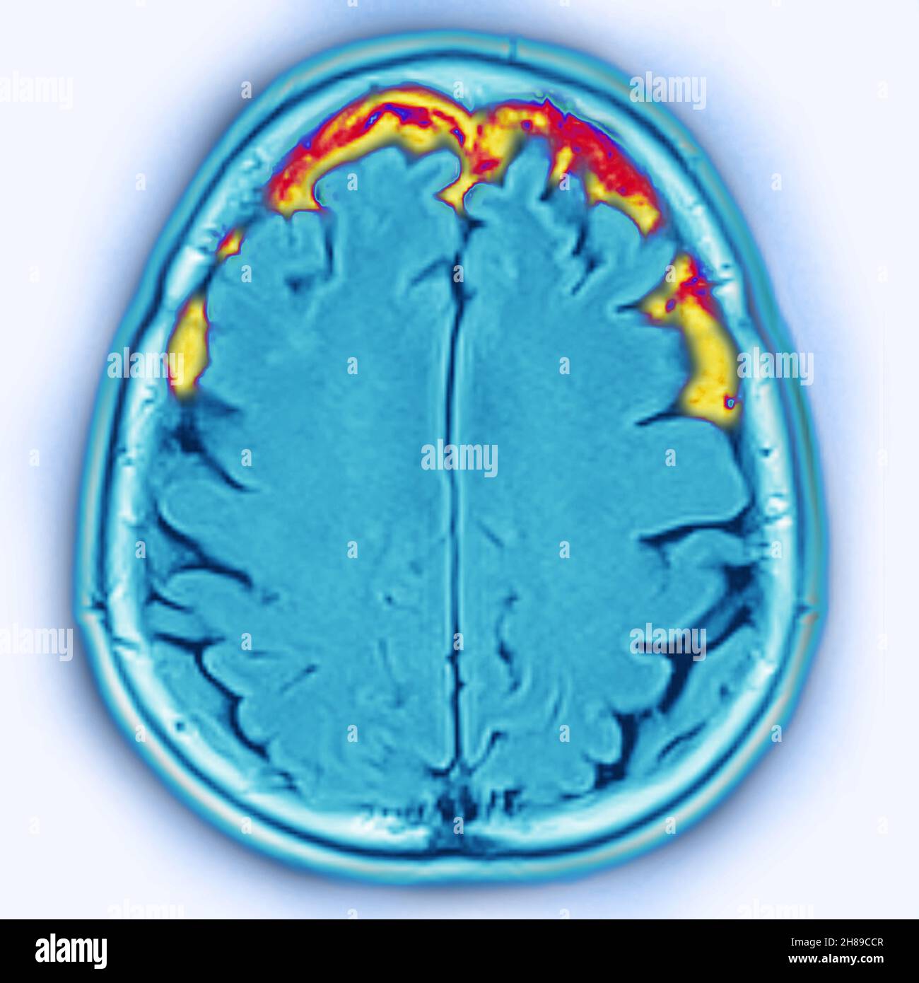 Cerebral cortex alzheimer hi-res stock photography and images - Alamy