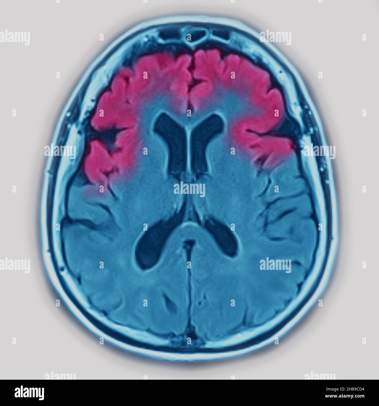 Brain atrophy alzheimer hi-res stock photography and images - Alamy
