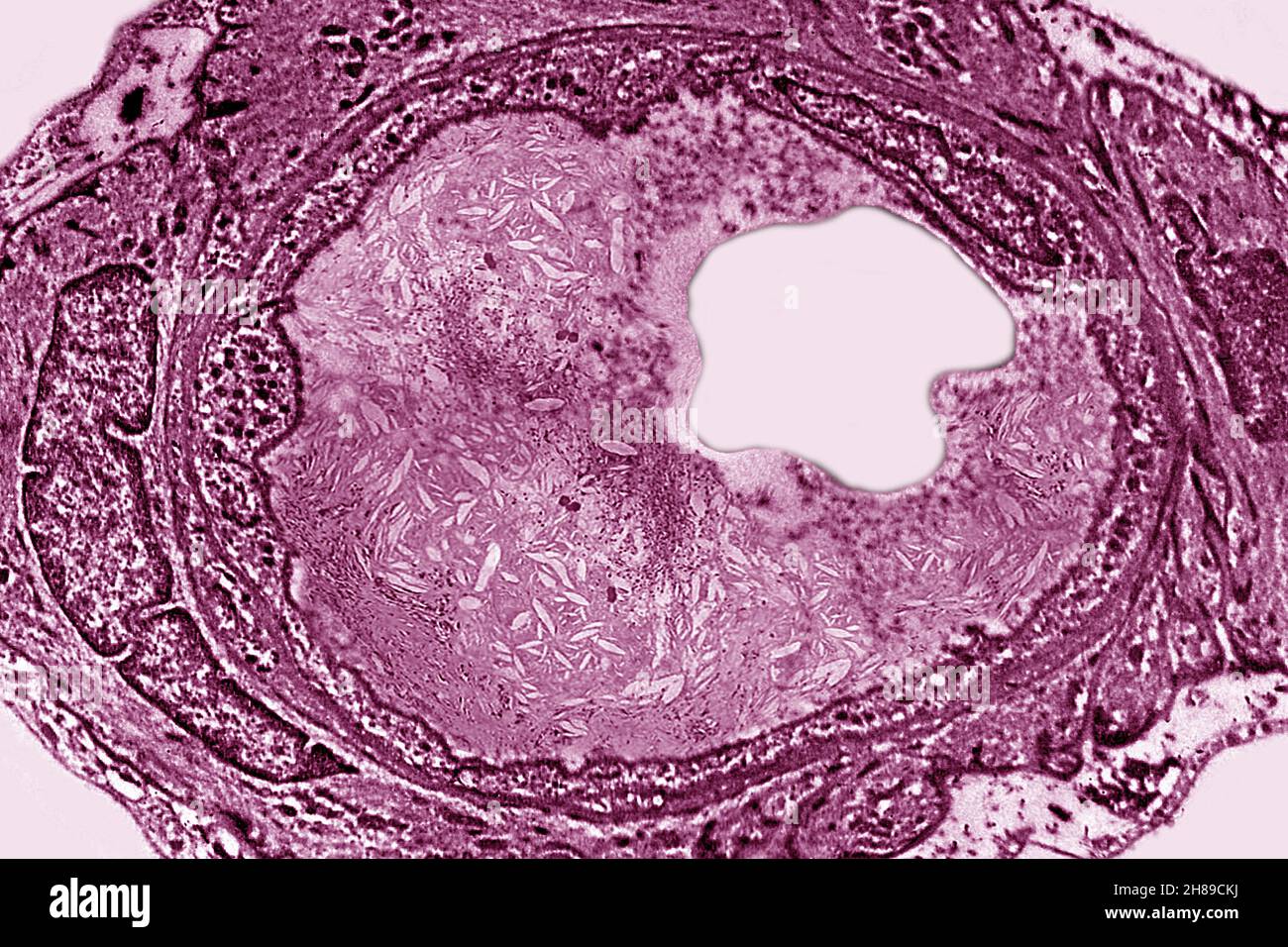 Atherosclerosis hi-res stock photography and images - Alamy