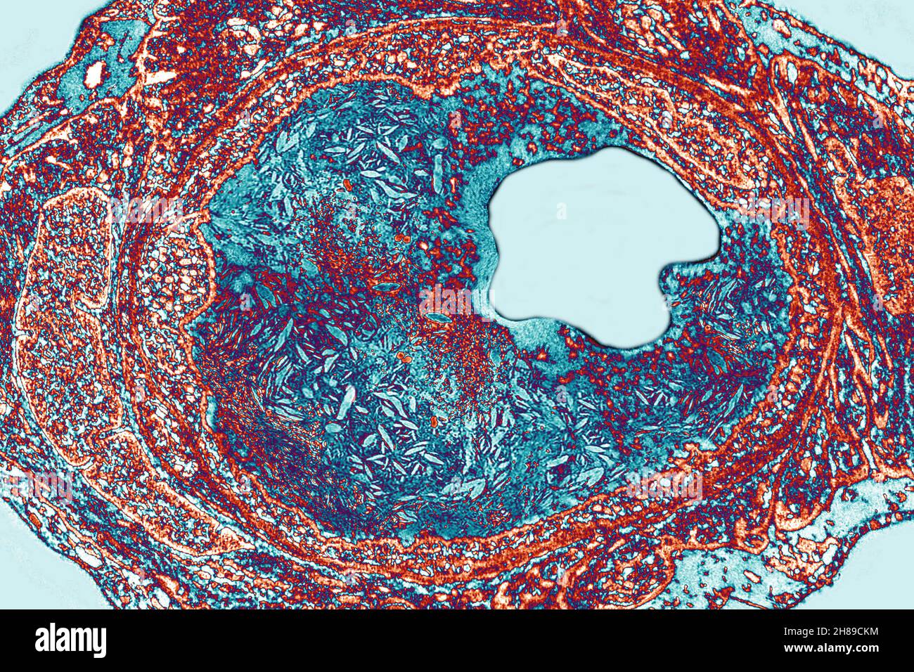 Atheroma histology hi-res stock photography and images - Alamy