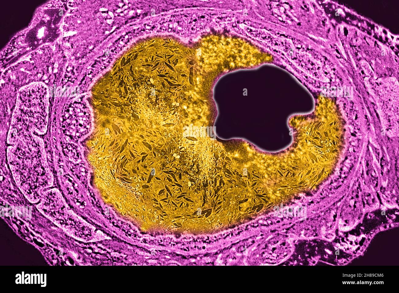 Atherosclerosis hi-res stock photography and images - Alamy