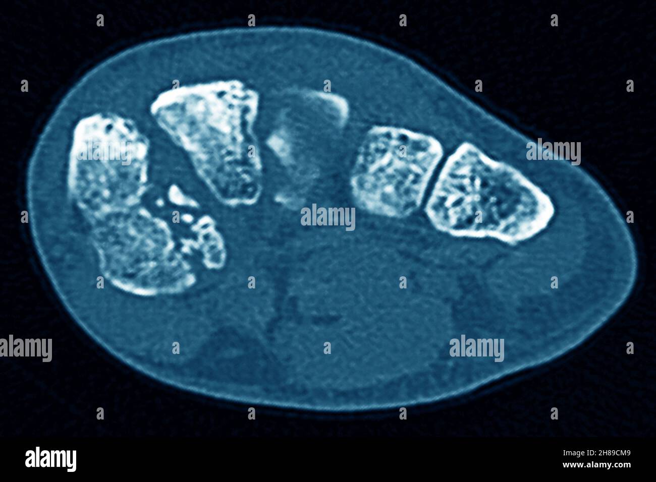 Cuneiform bone hi-res stock photography and images - Alamy