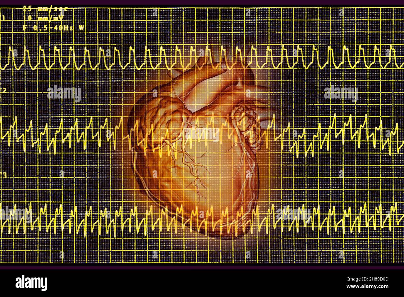 Atrial Fibrillation: What Are The Different Types?, 50% OFF