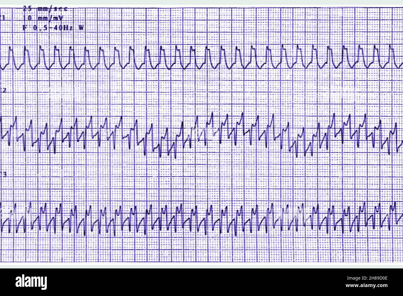 Ecg ekg pathology hi-res stock photography and images - Alamy